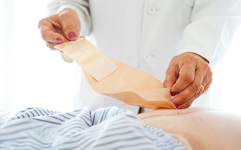 Managing Stoma Complications: Selecting the Best Colostomy Bags for Pr ...