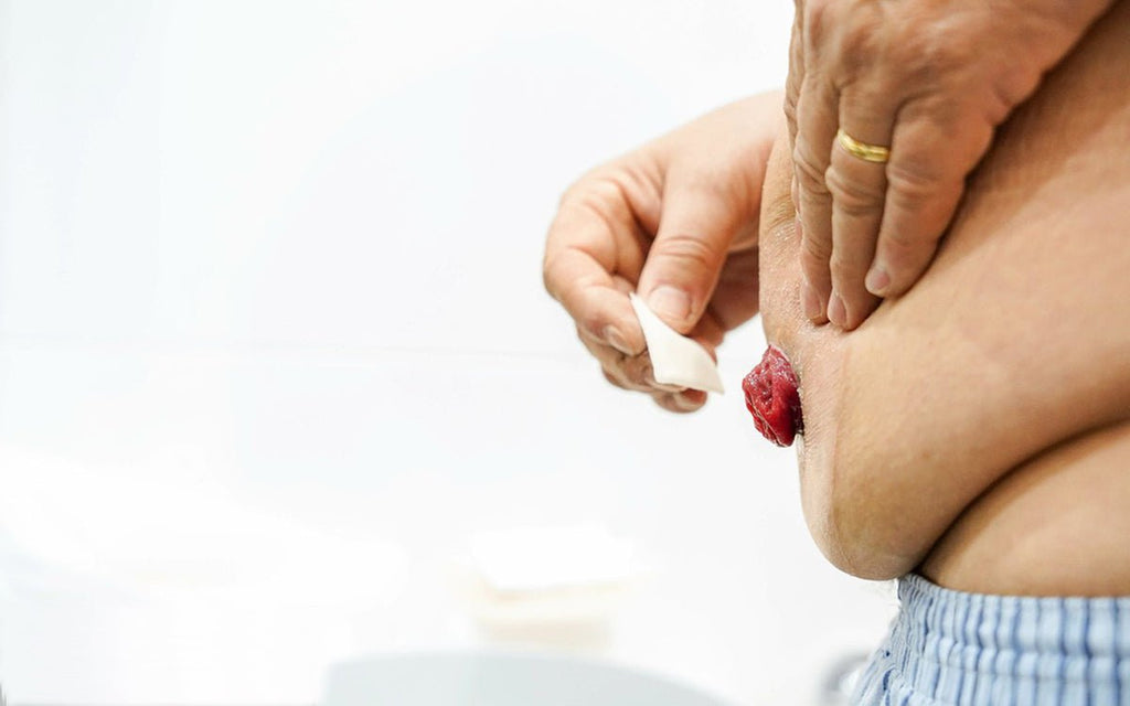 Surgery Care for Colostomy Patients – HEAGI - Colostomy bags Supplies