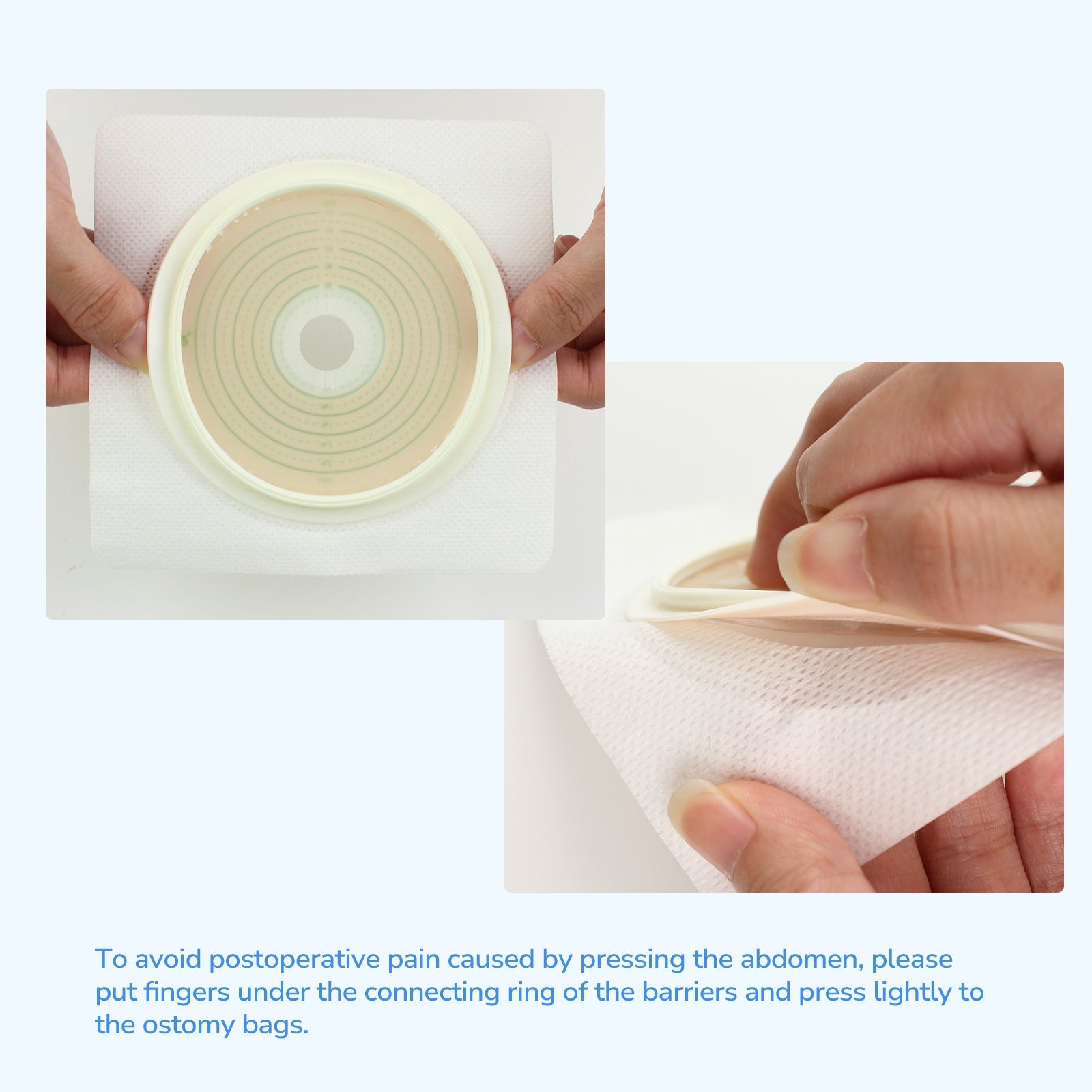 HEAGI Skin Barrier for 2-Piece Colostomy Bag Osotmy Bag – HEAGI ...